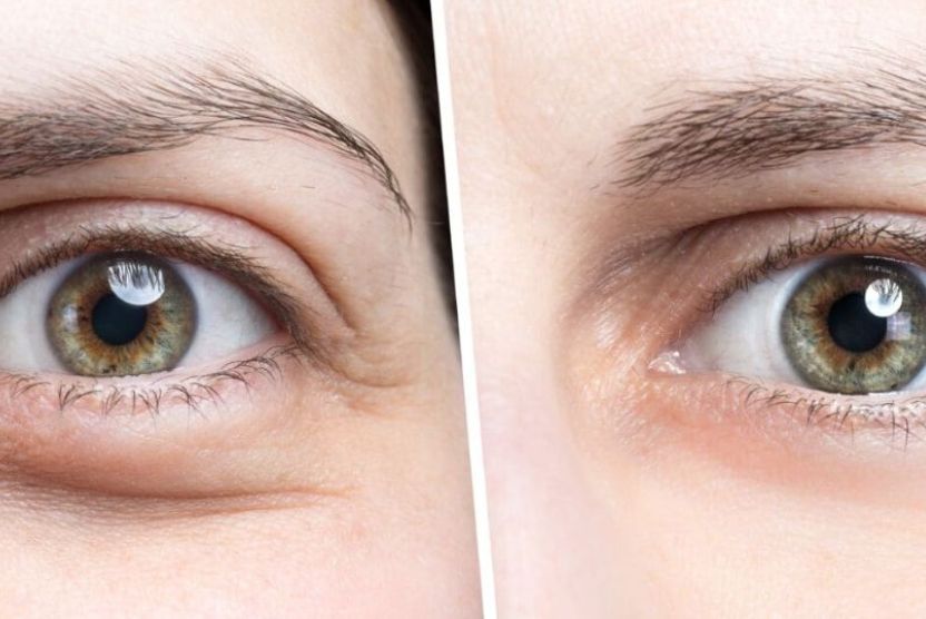 Botox Before And After Under Eyes Botox Under Eyes, Under Eye Bags