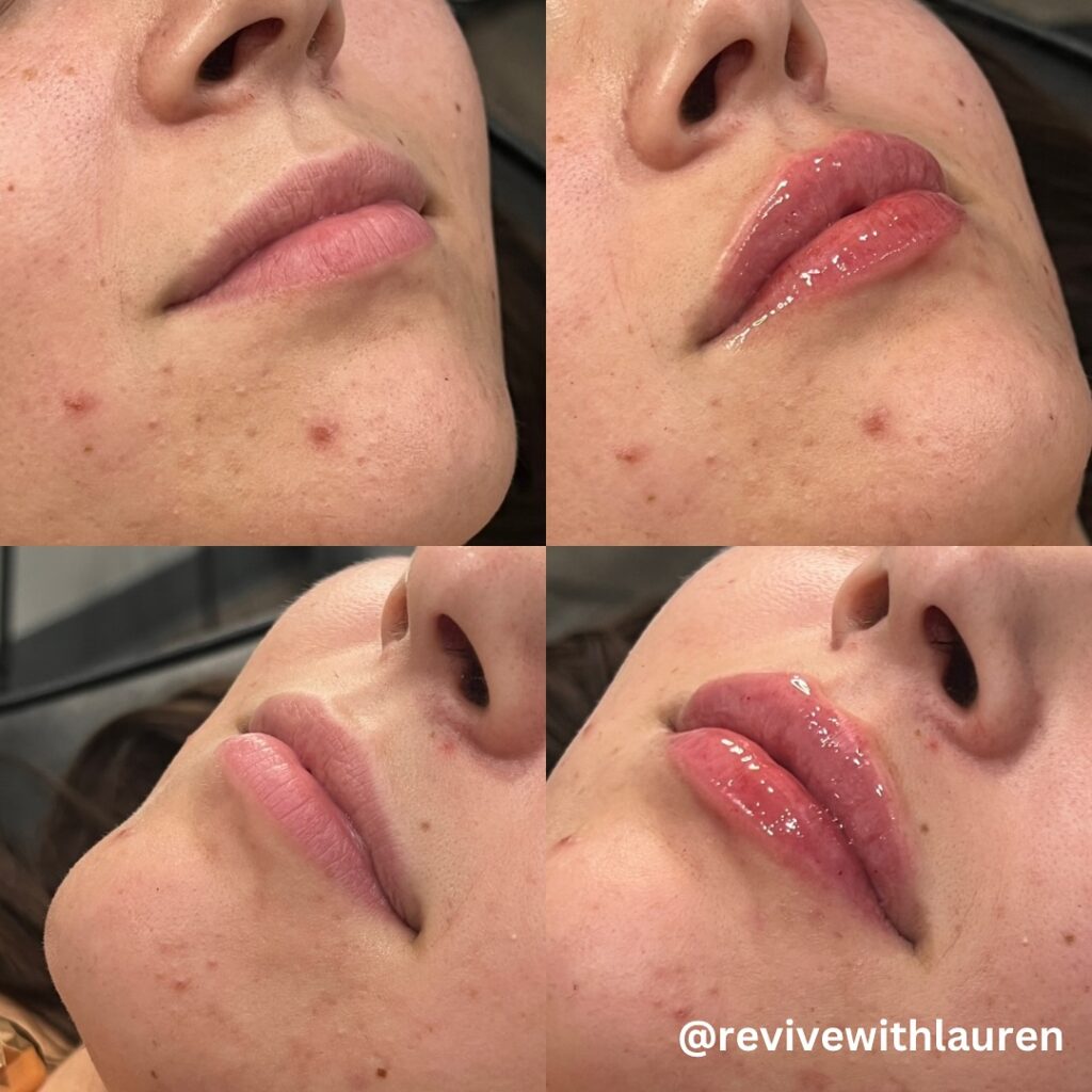 What Is A Lip Flip Treatment?